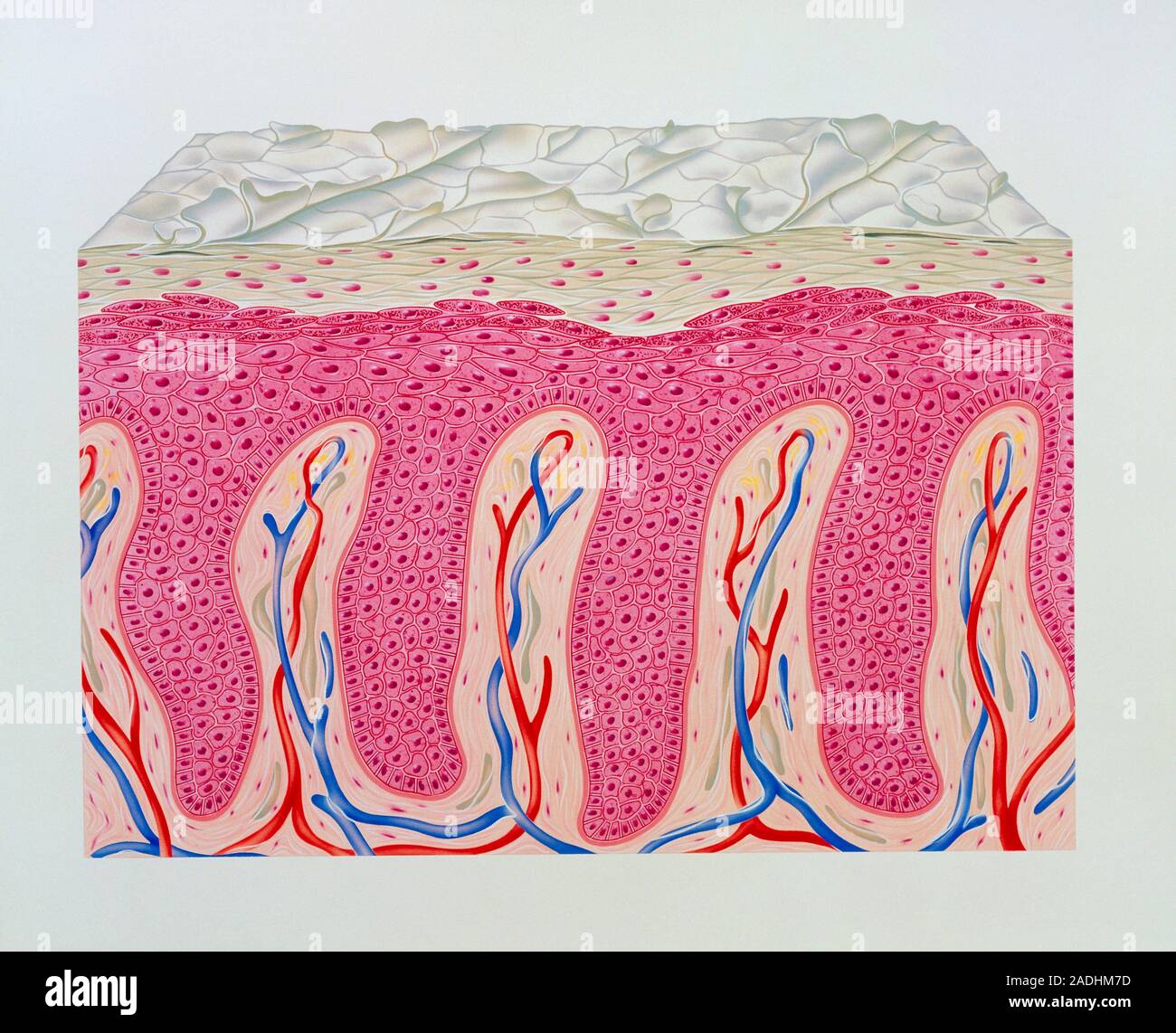 Psoriasis. Illustration of a microscopic view of a slice through the ...
