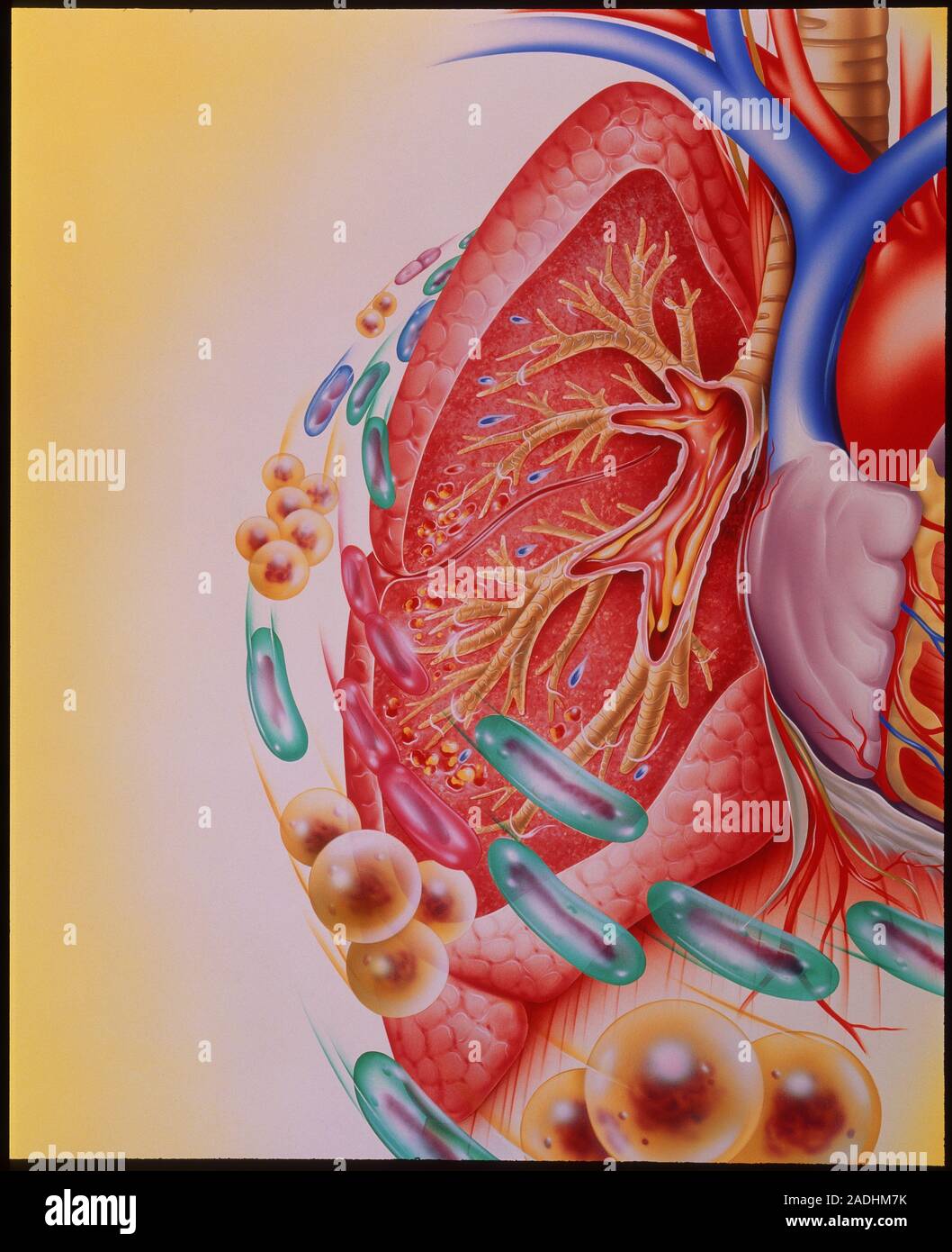Pulmonary infection. Illustration showing an infected lung and ...
