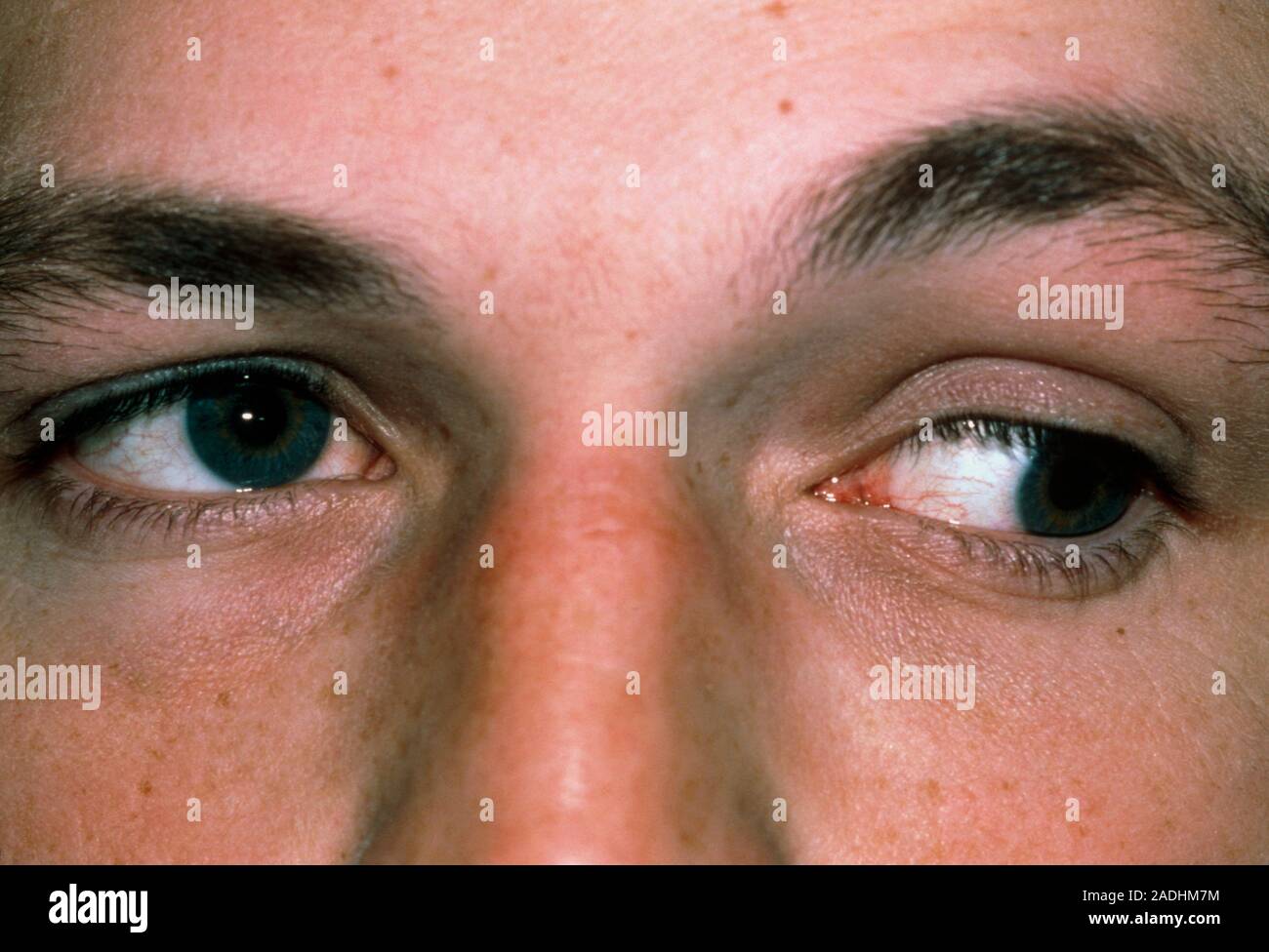 Congenital palsy. Patient affected by squint in the left eye (right of ...
