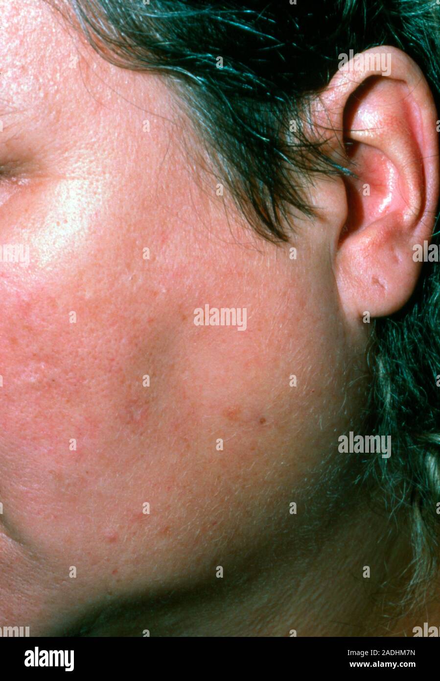 Parotid swelling. The swollen parotid gland of a patient suffering from ...