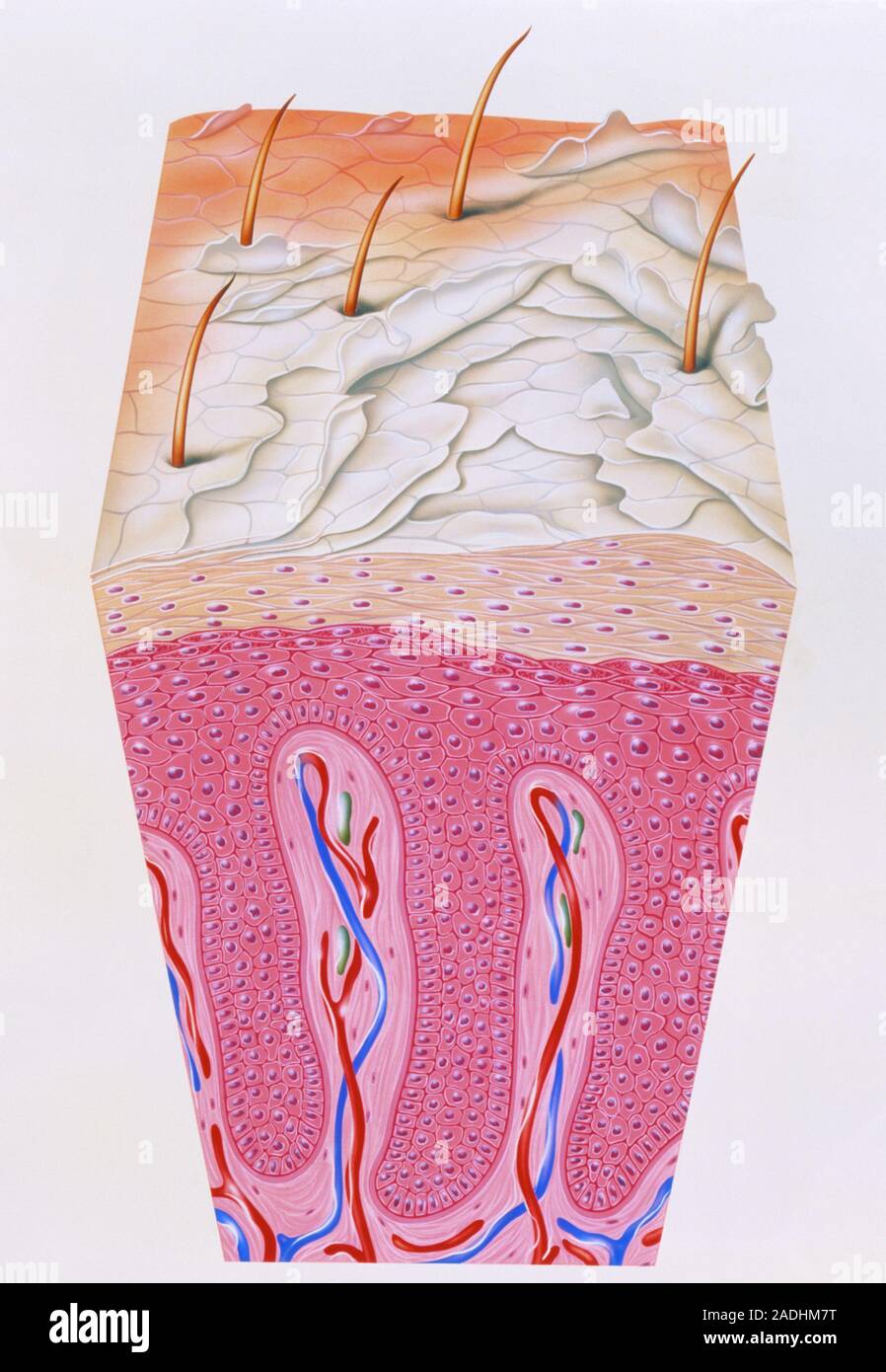 Psoriasis. Illustration of a section through the epidermis of human ...