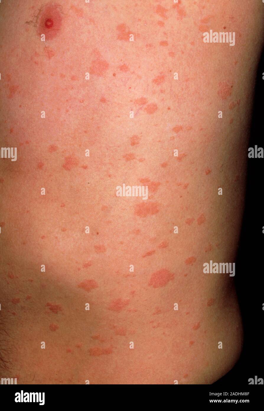 Pityriasis rosea. View of the trunk of a 27 year- old man covered with ...