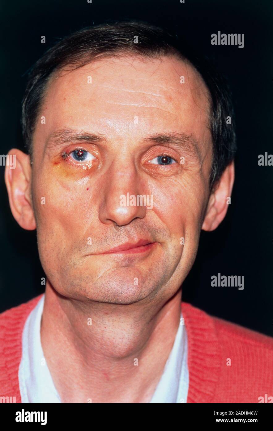 Facial paralysis. Paralysis (palsy) of one side of the face in a 50 ...