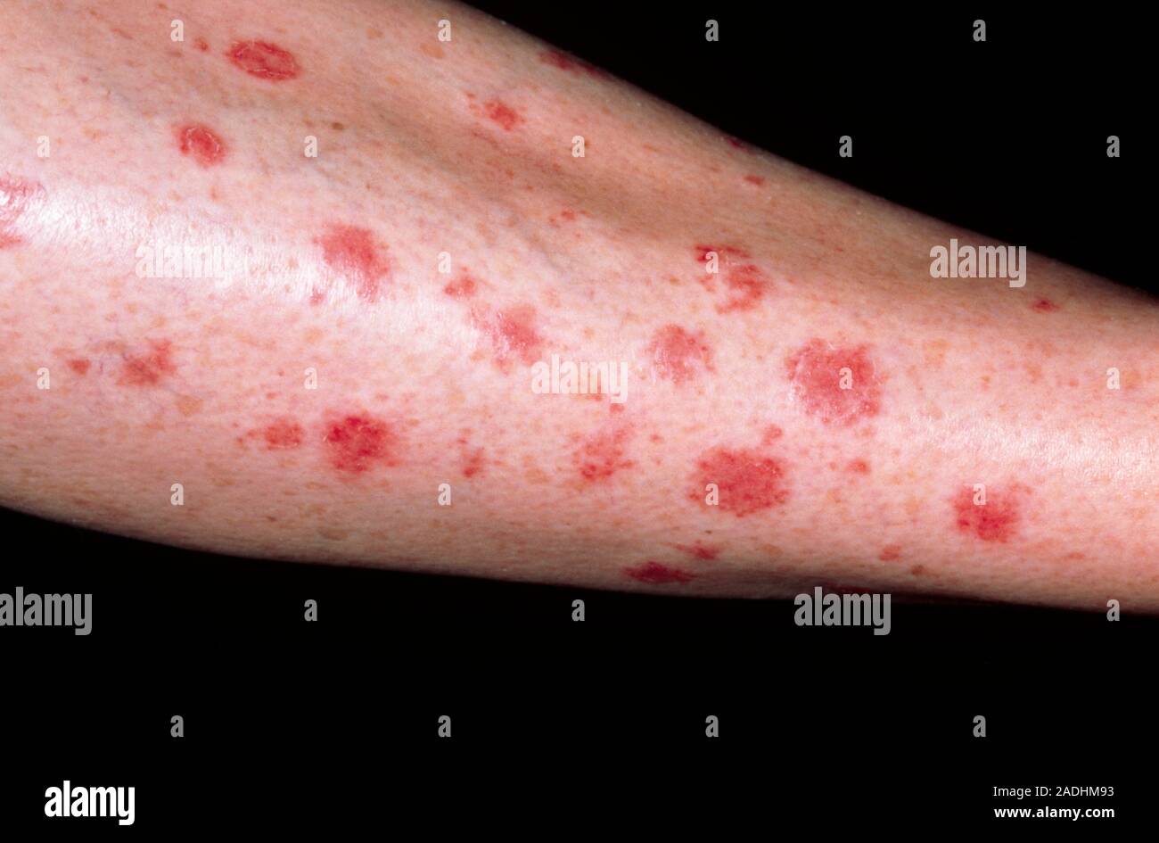Psoriasis. Close-up of the leg of a 56 year old woman showing the skin ...