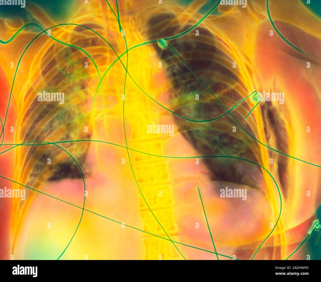 Pneumothorax treatment. Coloured chest X-ray of a 51 year old woman ...