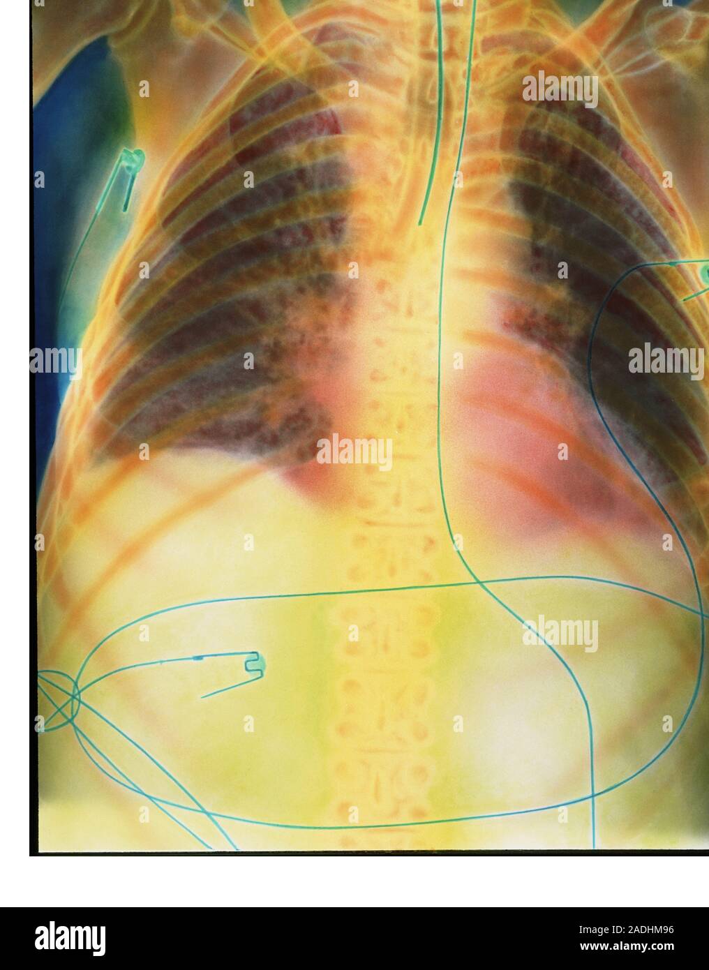 Pneumothorax treatment. Coloured chest X-ray of a an 69 year old man ...