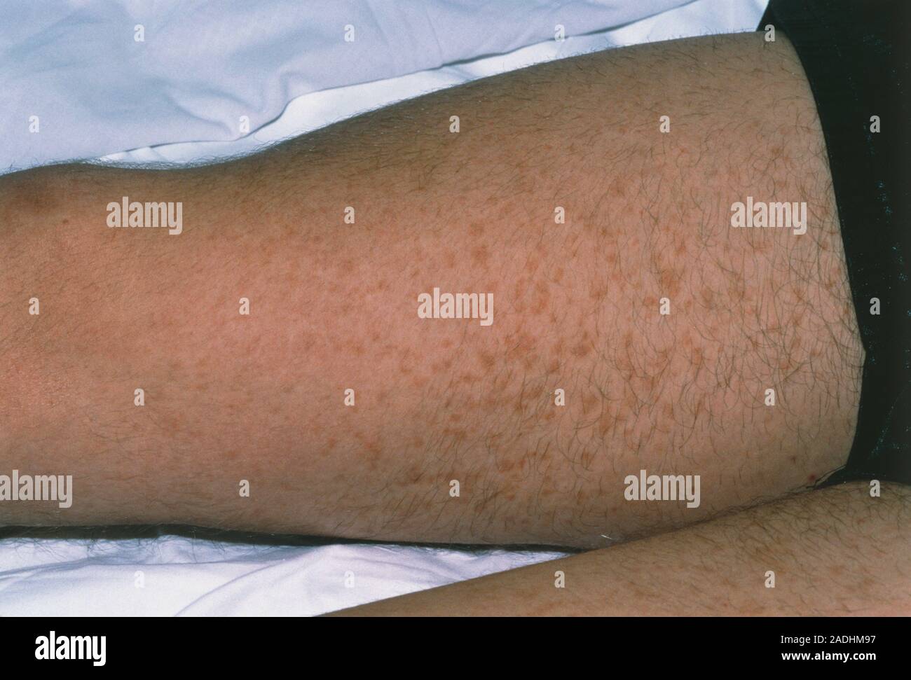Henoch-Schonlein purpura. Purple rash seen on the thighs of a man ...