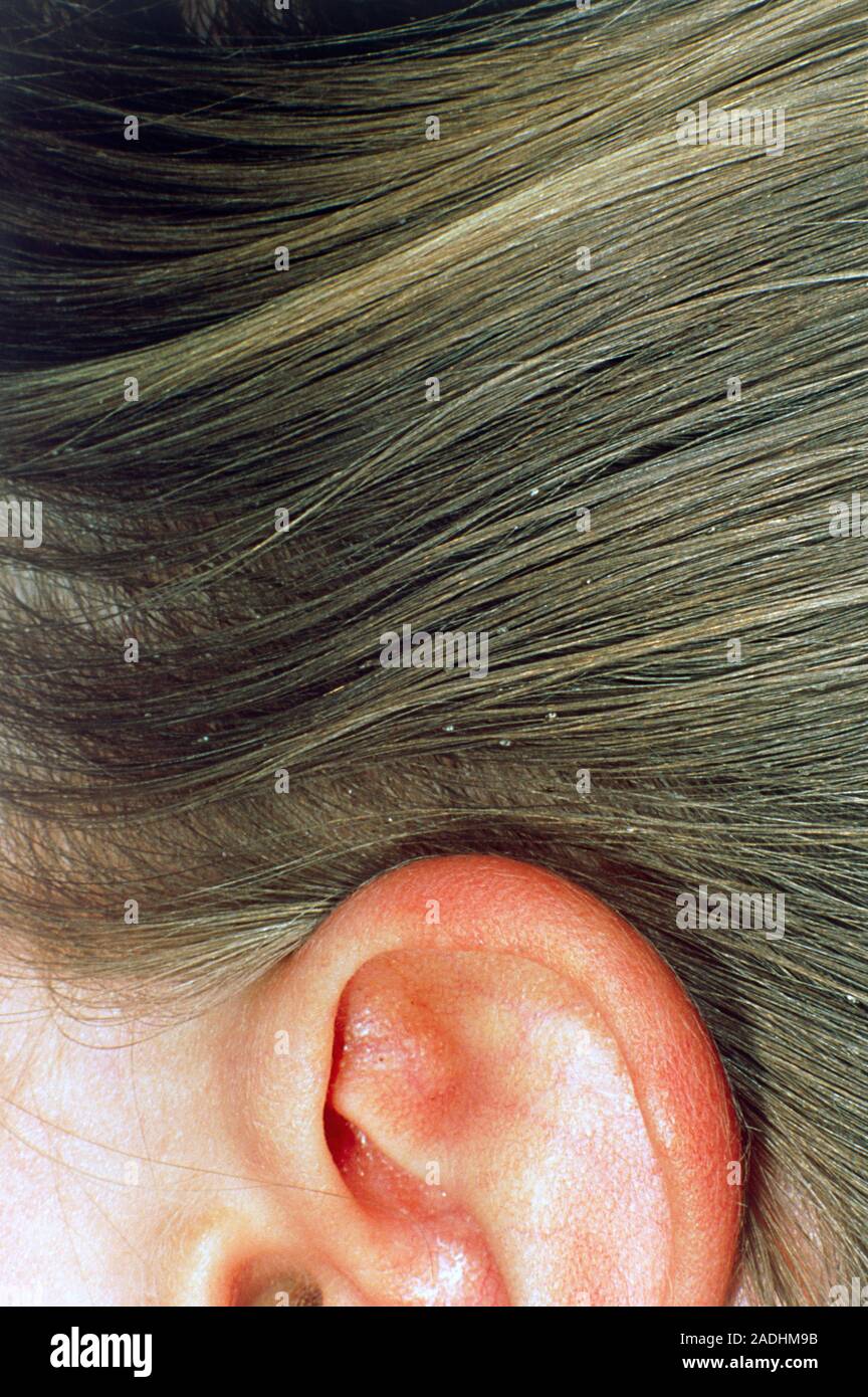 Nits. View of nits (head louse eggs) in human hair. The nits are the ...