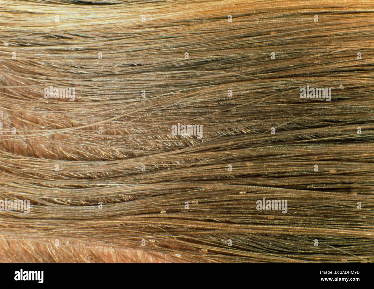Nits. View of nits (head louse eggs) in human hair. The nits are the ...