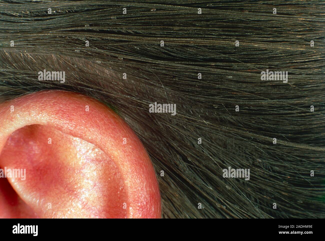 Nits. View of nits (head louse eggs) in human hair. The nits are the ...