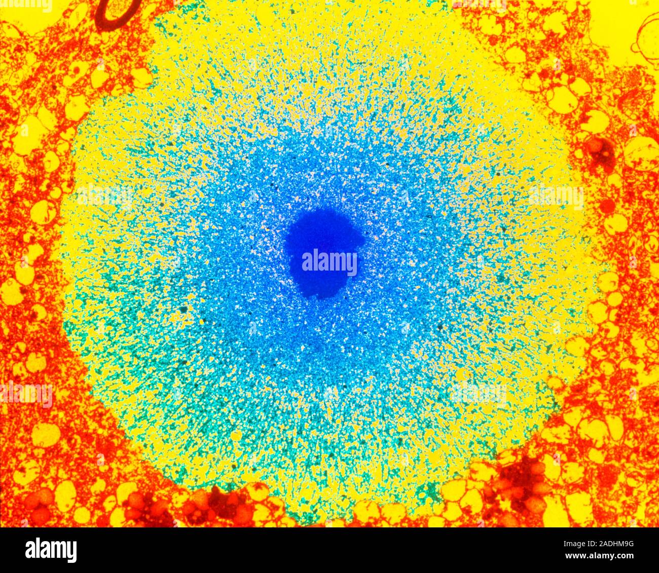 Parkinson's disease. Coloured transmission elect- ron micrograph (TEM ...