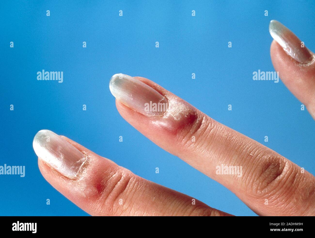 Acute paronychia. Close-up of fingers showing acute paronychia. This is ...