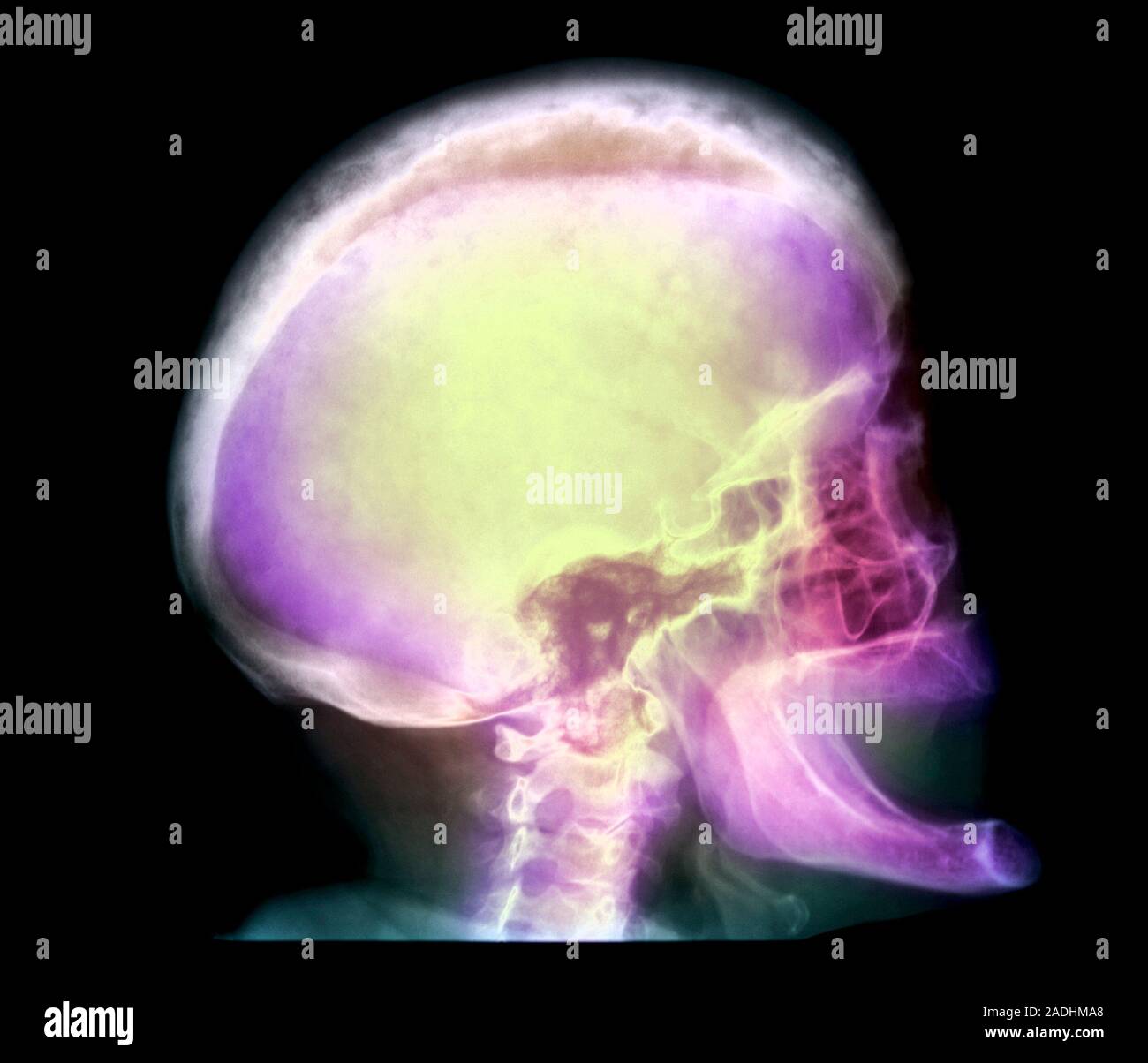 Paget's disease. Coloured X-ray showing a skull in Paget's disease or ...