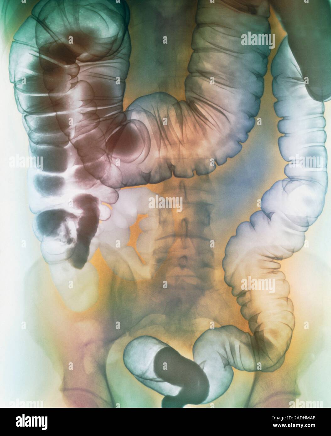 Proctitis. Coloured barium enema X-ray of the abdomen of a male patient ...