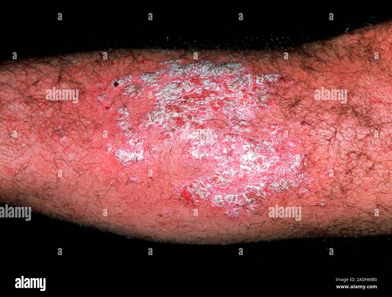 Psoriasis. Arm of a 51-year-old man suffering from the skin disease ...
