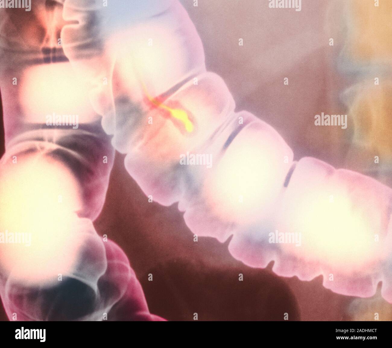 Colonic polyp. Coloured barium X-ray of a pedunculate (stalked) polyp ...