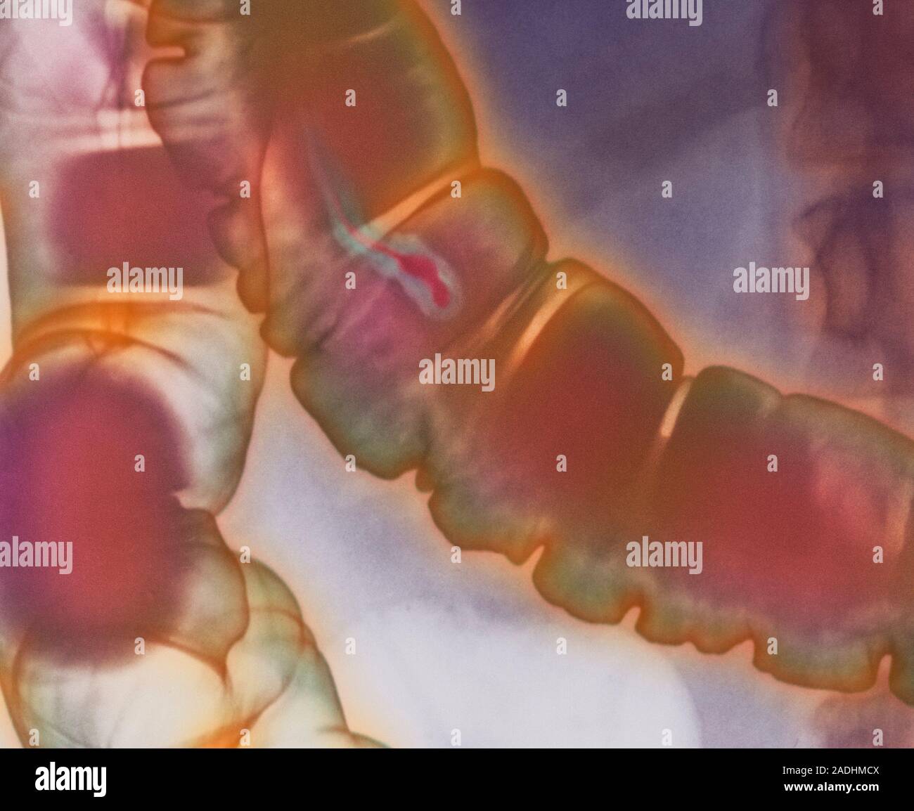 Colonic polyp. Coloured barium X-ray of a pedunculate (stalked) polyp ...