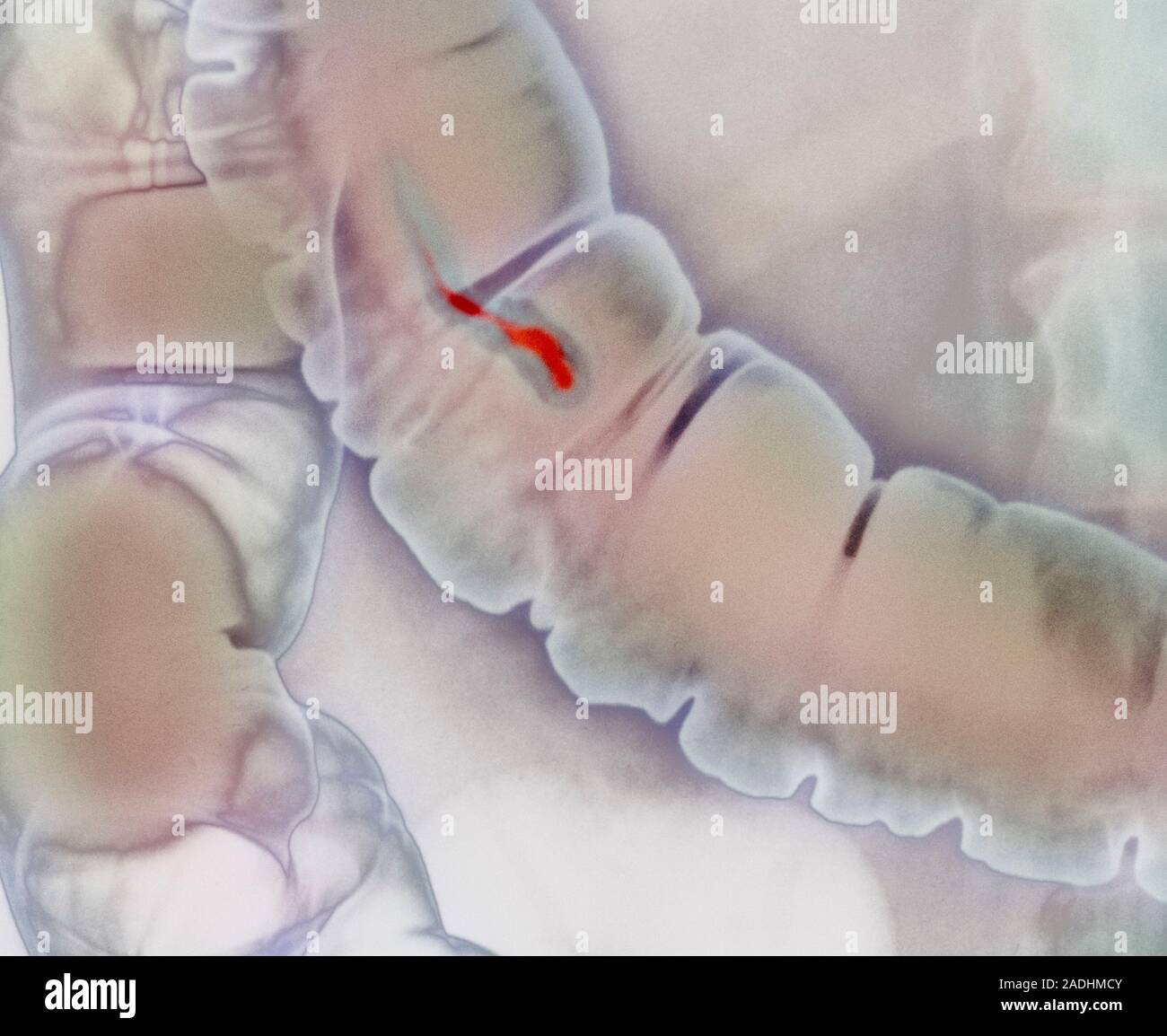 Colonic polyp. Coloured barium X-ray of a pedunculate (stalked) polyp ...