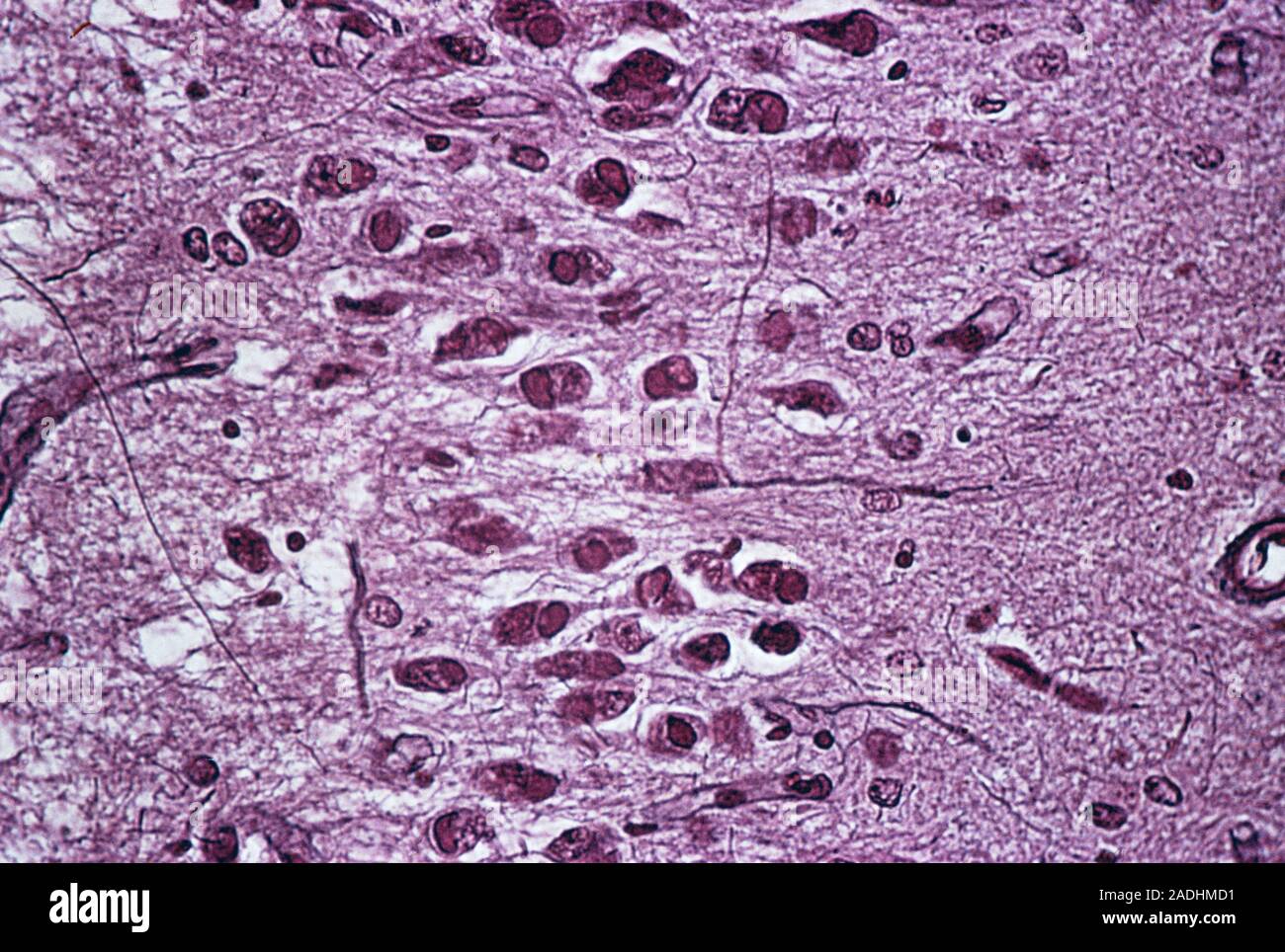 Pick's disease. Light micrograph of a section through the brain of a ...