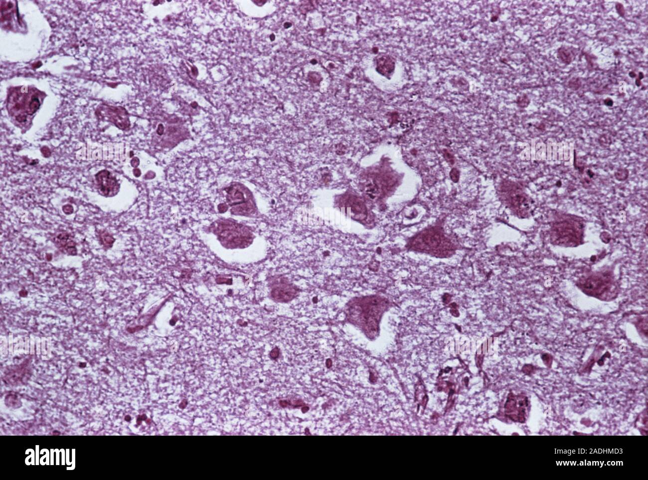 Pick's disease. Light micrograph of a section through the brain of a ...