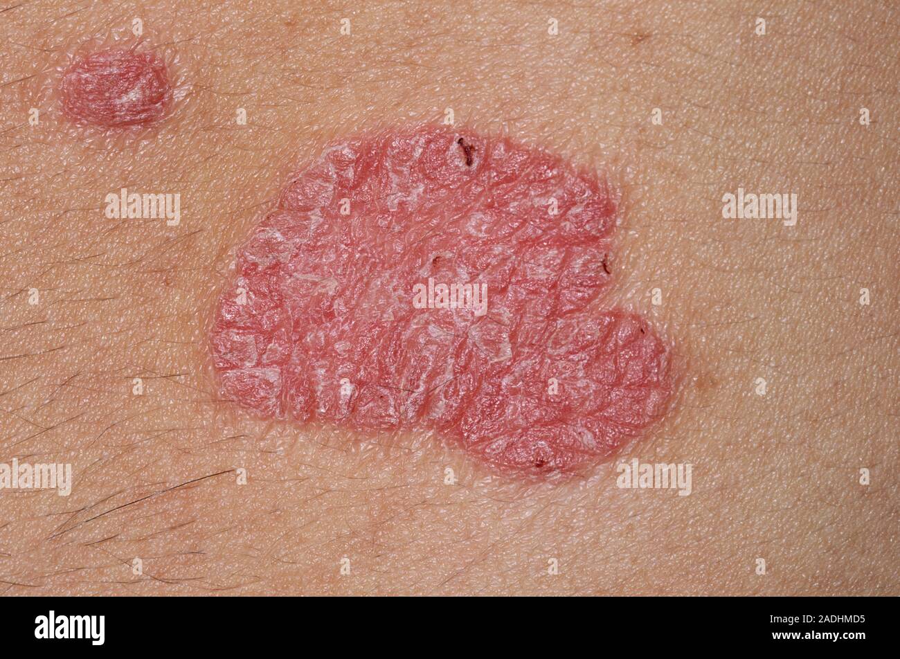 Psoriasis on the skin of a 39-year-old man suffering from discoid, or plaque, psoriasis. The ...