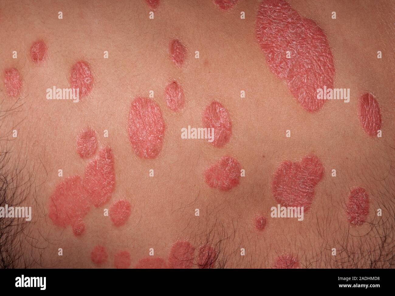 Psoriasis on the skin of a 39-year-old man suffering from discoid, or ...
