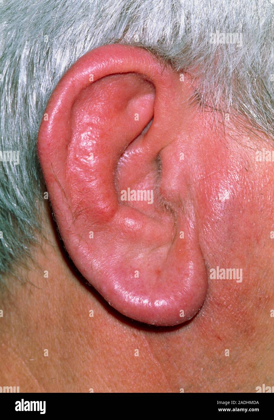 Perichondritis ear infection. Inflamed outer ear of a 61-year-old man ...