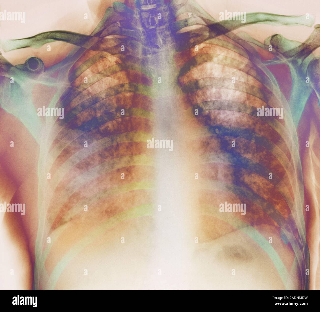 Pneumonia. Coloured chest X-ray of a 54 year old man, showing pulmonary ...
