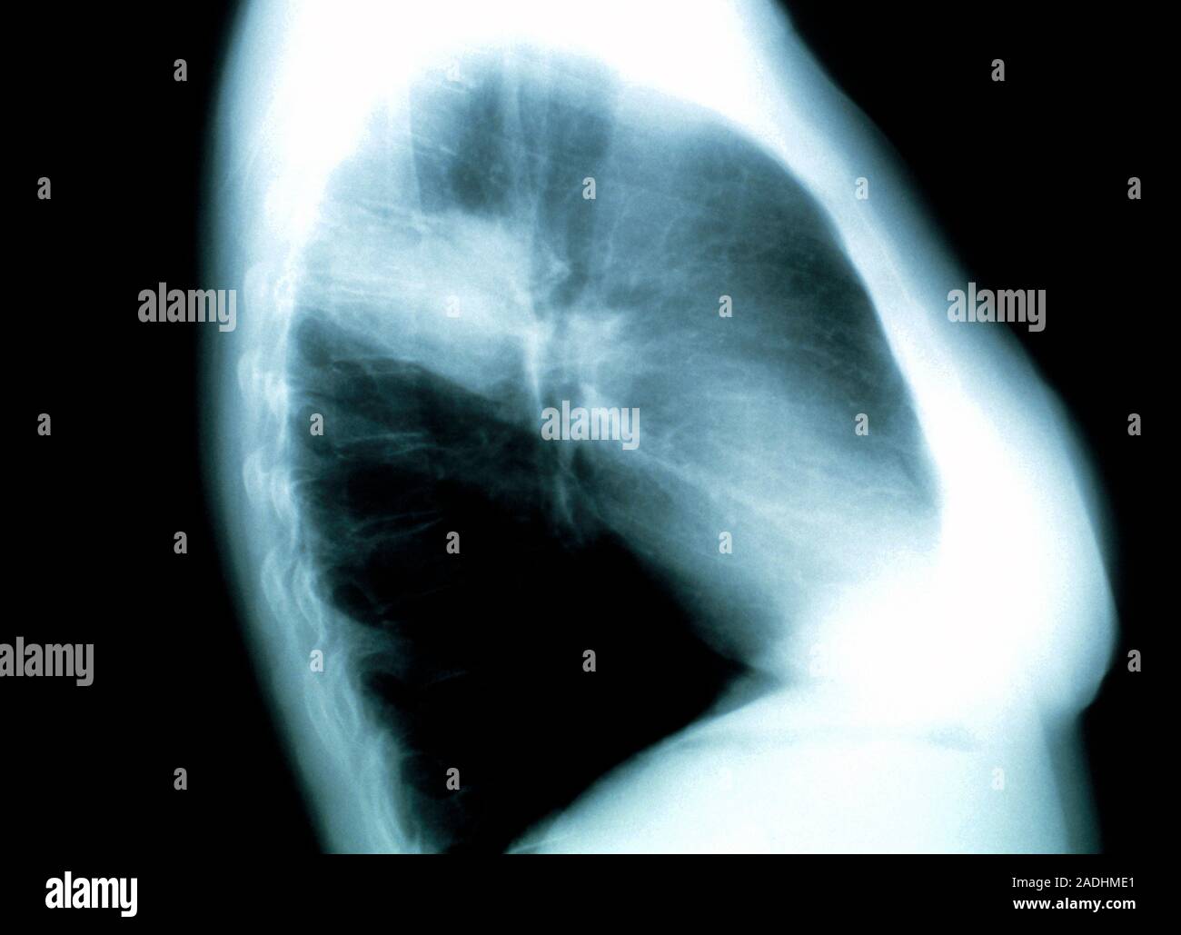 Pneumonia. X-ray of a patient's right lung seen from the side, showing ...