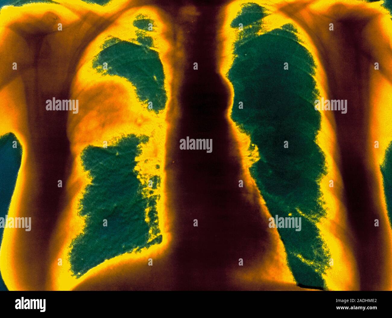 Pneumonia. Coloured frontal chest X-ray of the lungs (green) of a ...