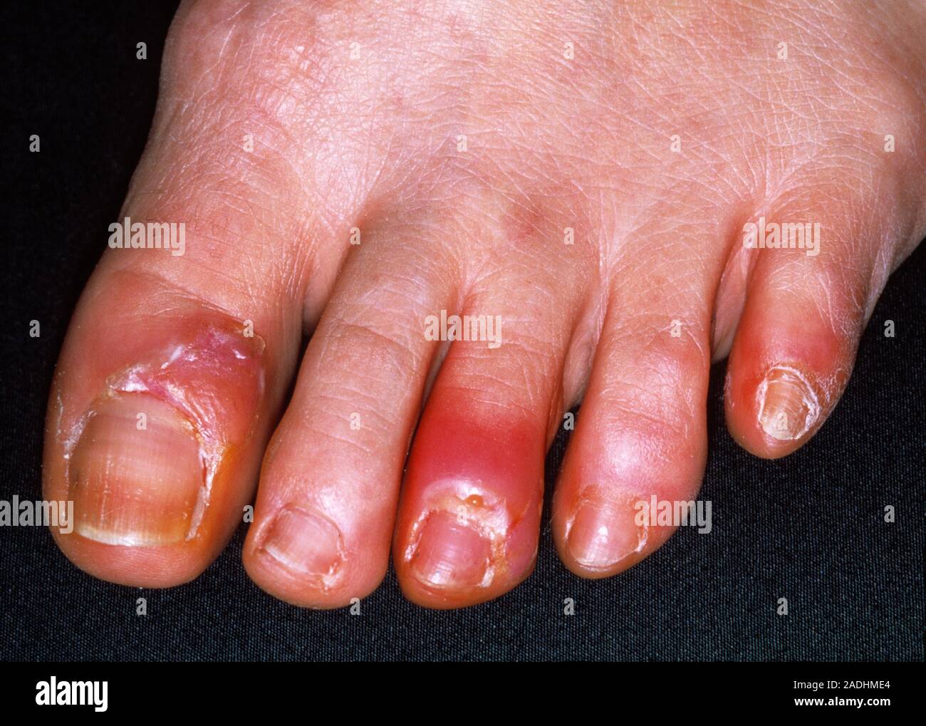 Paronychias on toes. Pus (yellow) leaking from paryonychias, or ...