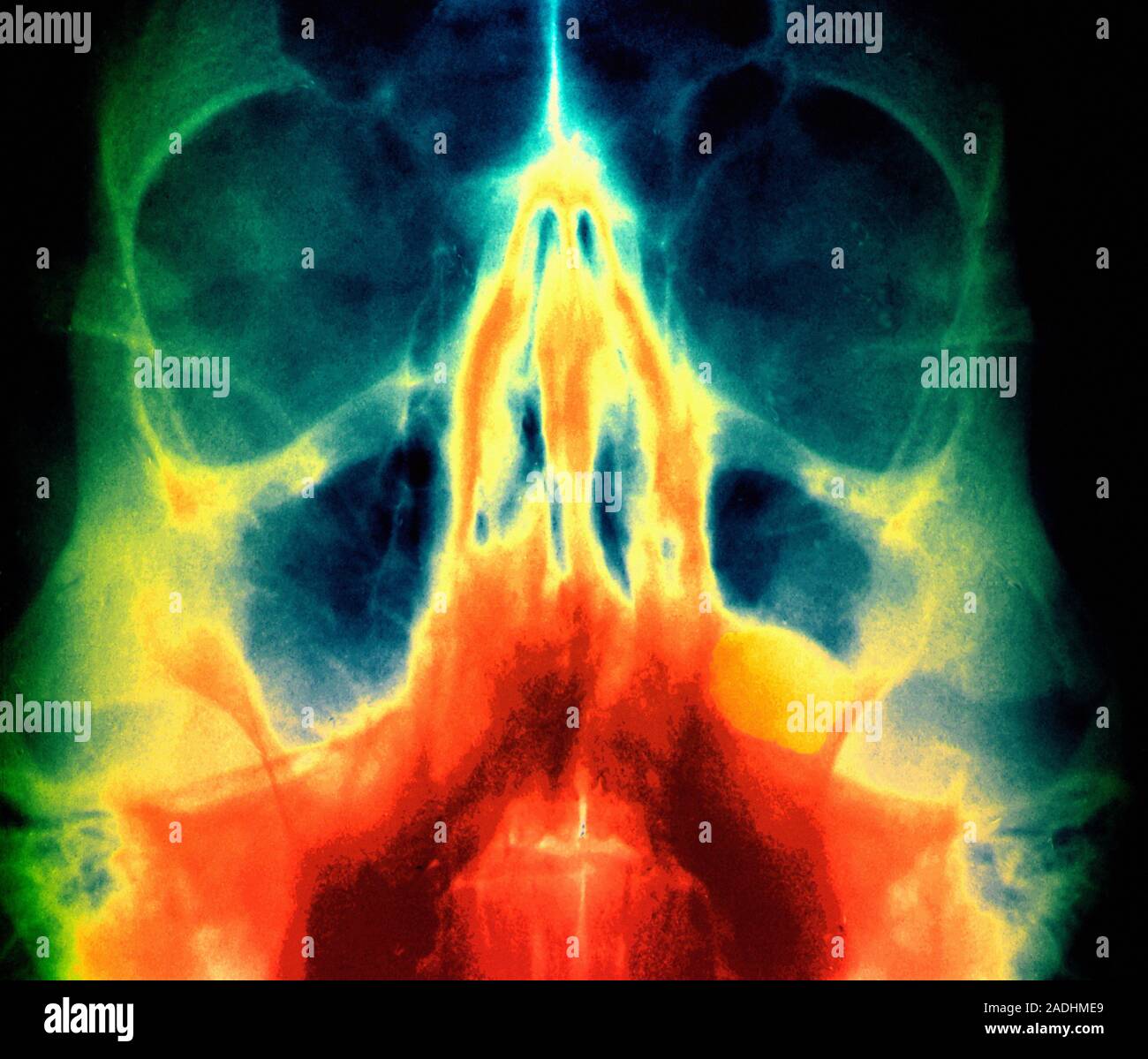 Sinus polyp. Coloured frontal X-ray of the skull of a patient with a ...