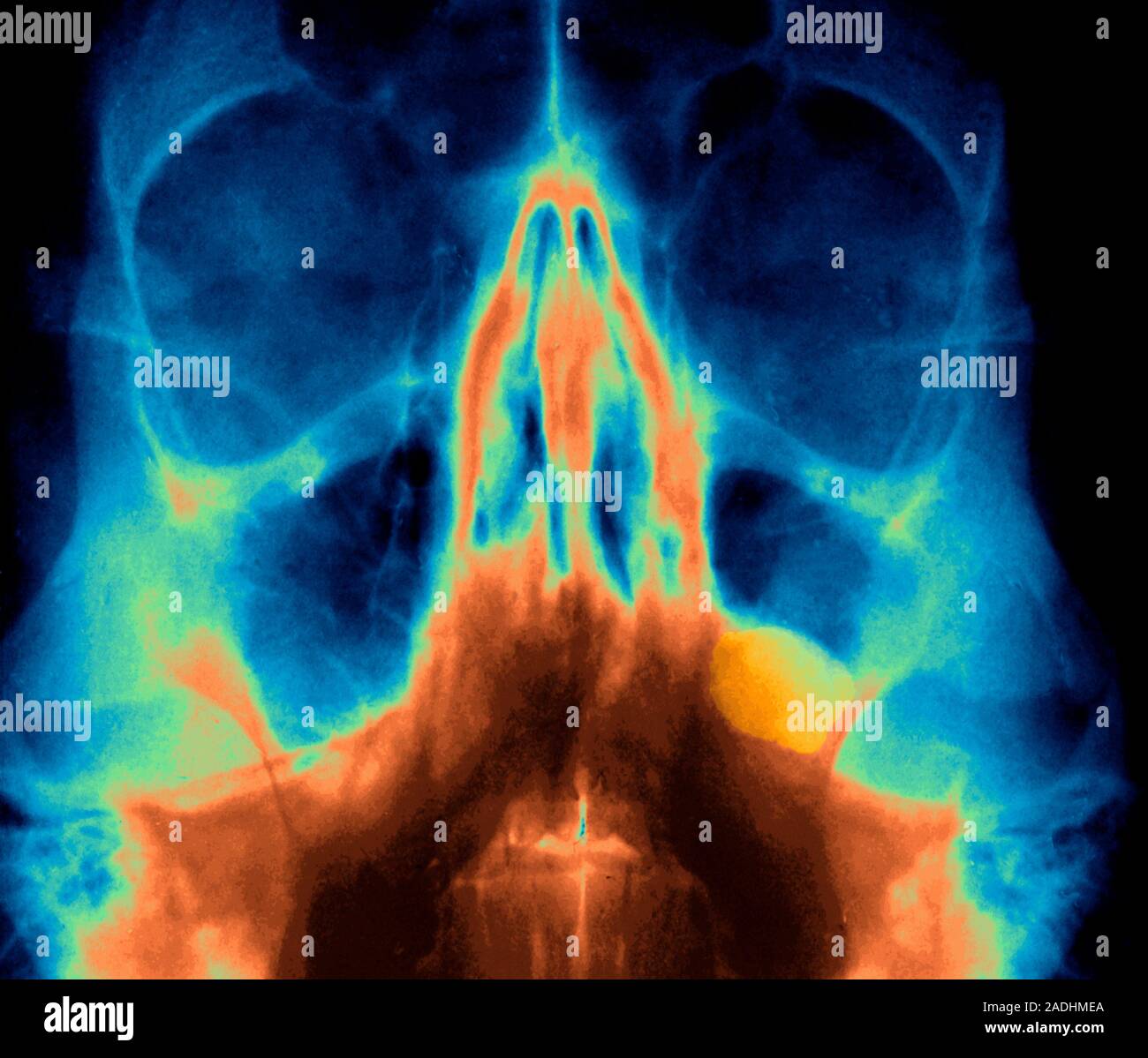Sinus polyp. Coloured frontal X-ray of the skull of a patient with a ...