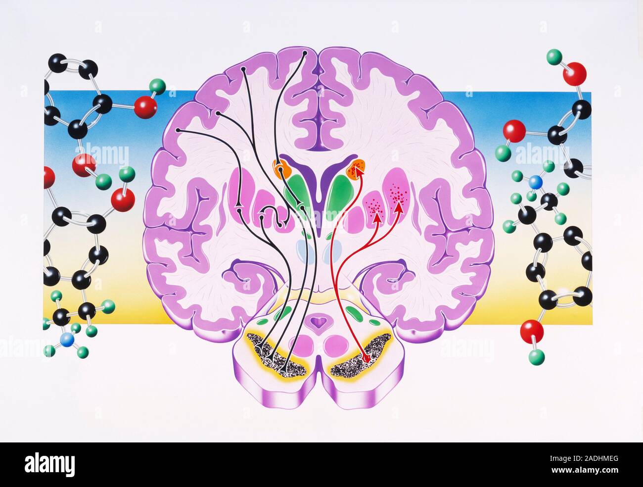 Parkinson's disease. Artwork of a coronal section (frontal) through a ...