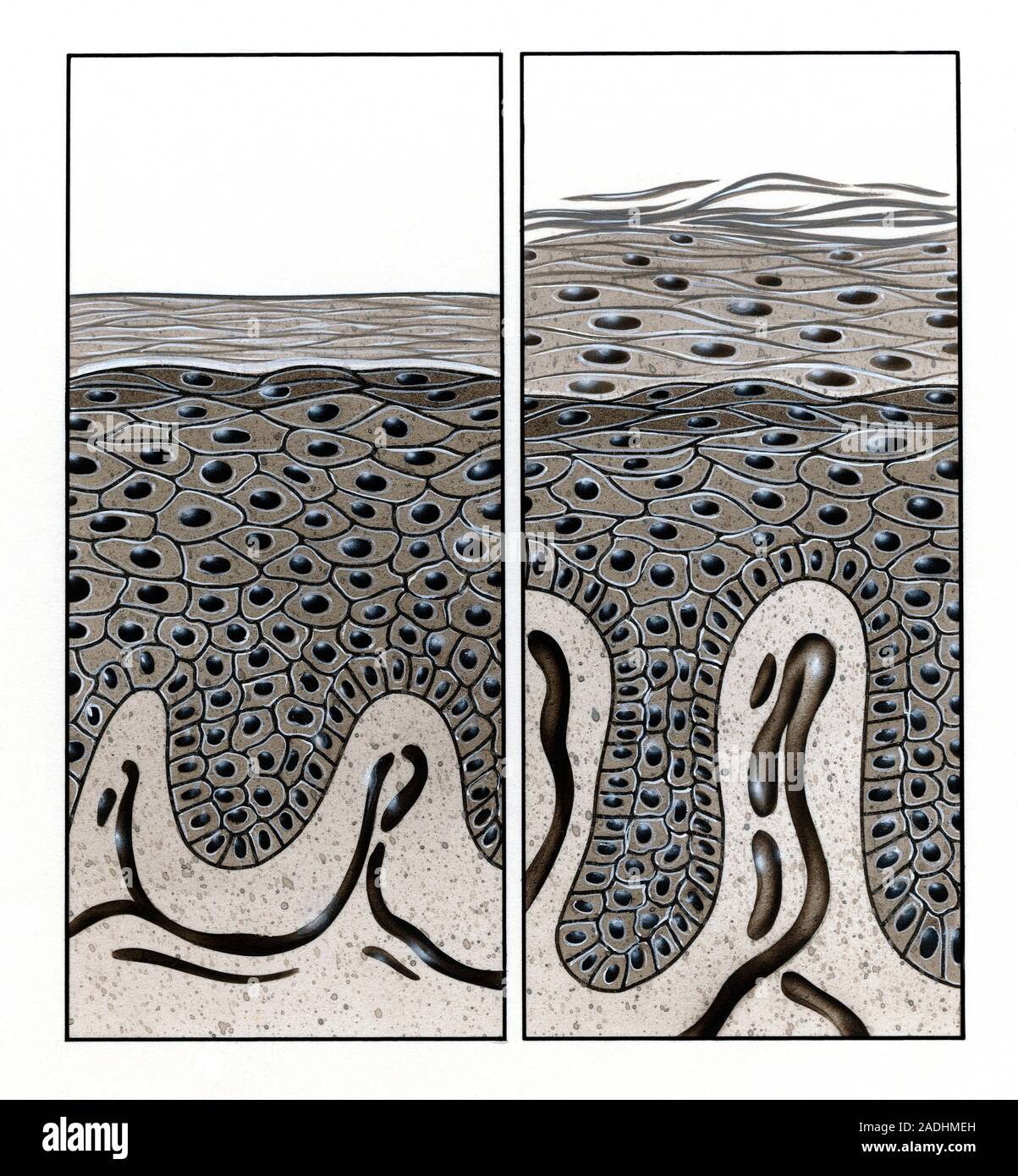 Psoriasis. Artwork comparing two sections through human skin: healthy ...