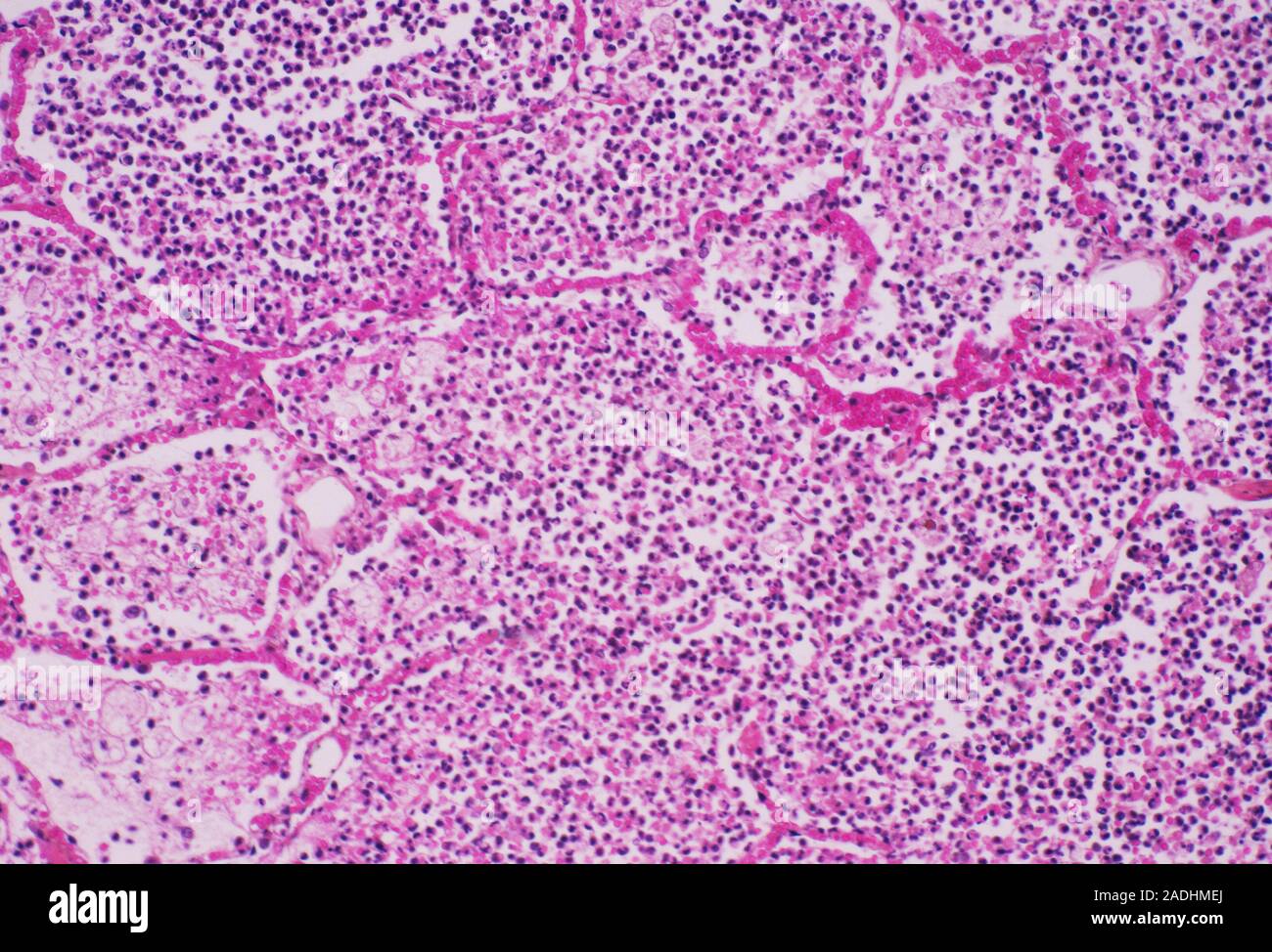Bronchopneumonia. Light micrograph of a section through lung tissue ...