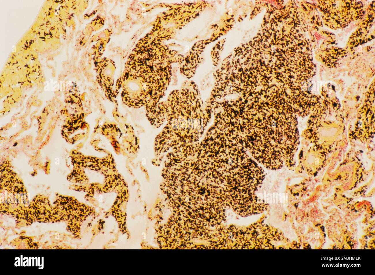 Dust inhalation lung disorder. Light micrograph of a section through ...