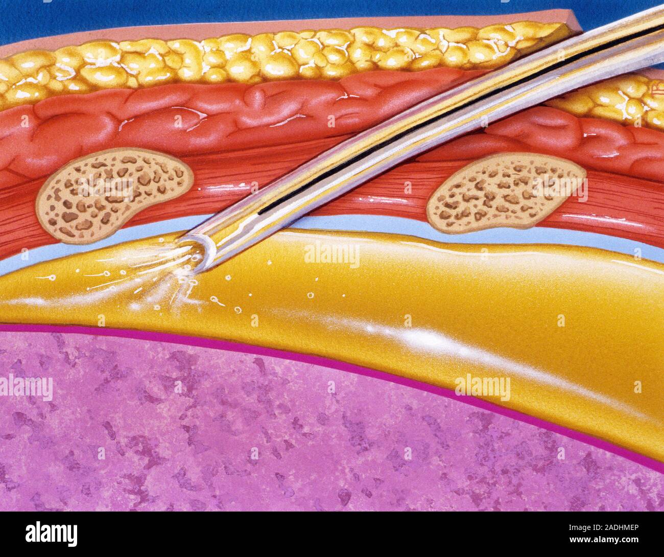Pleural effusion. Artwork of a tube suctioning fluid from around a lung ...