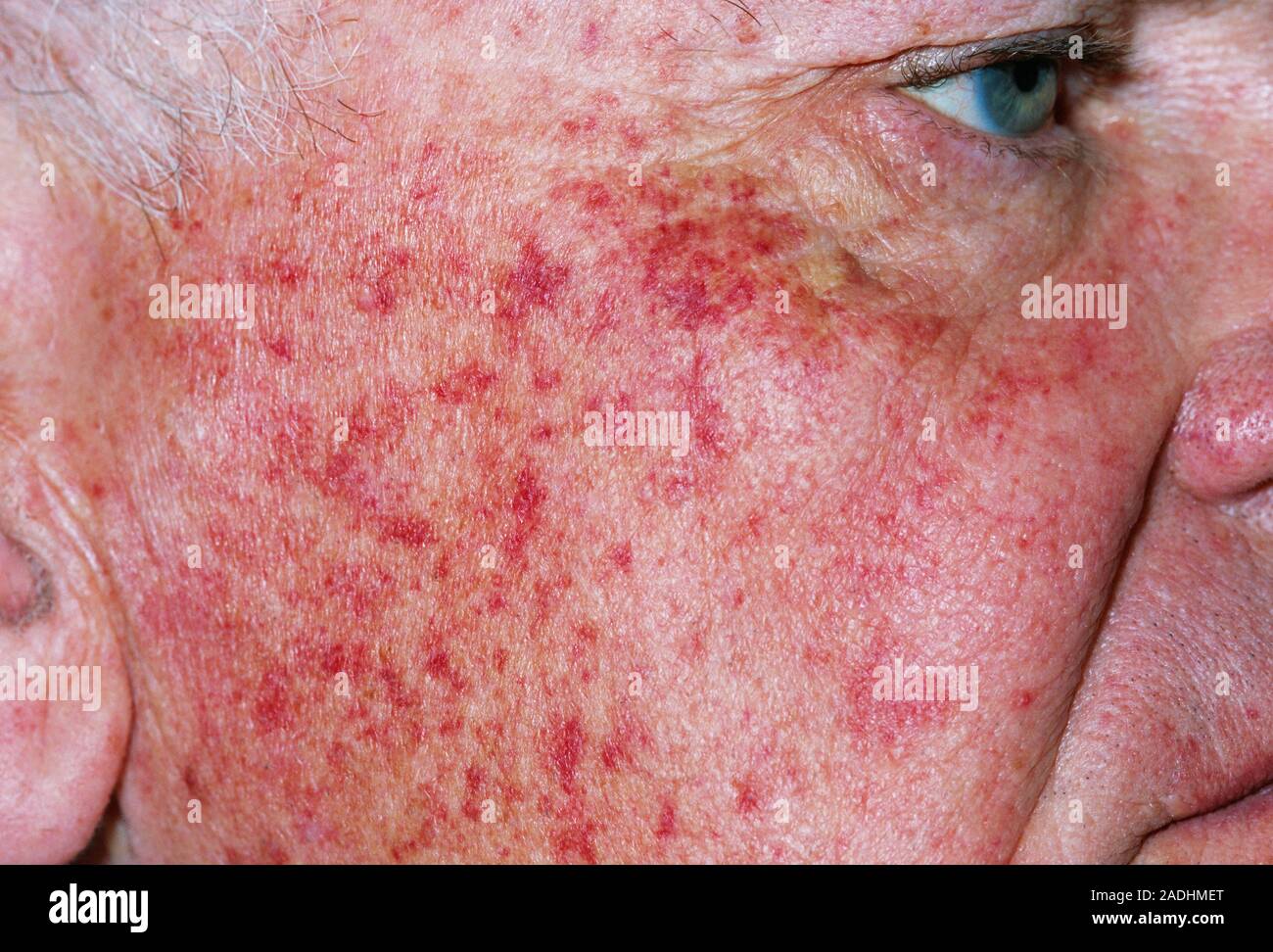 Petechial rash. cheek of a 67- year-old man showing small pin-point ...