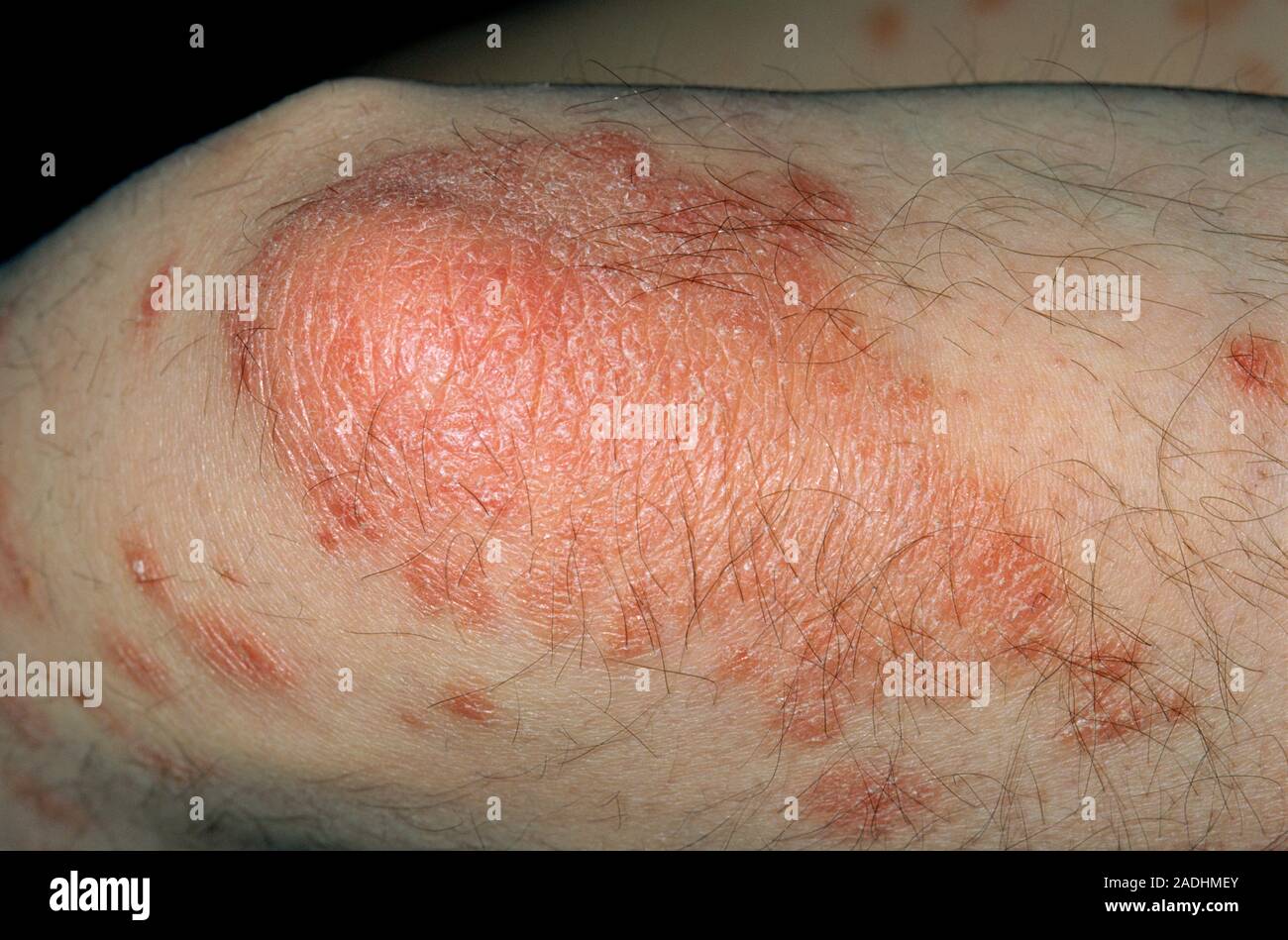 What are we doing about this shedding? : r/Psoriasis