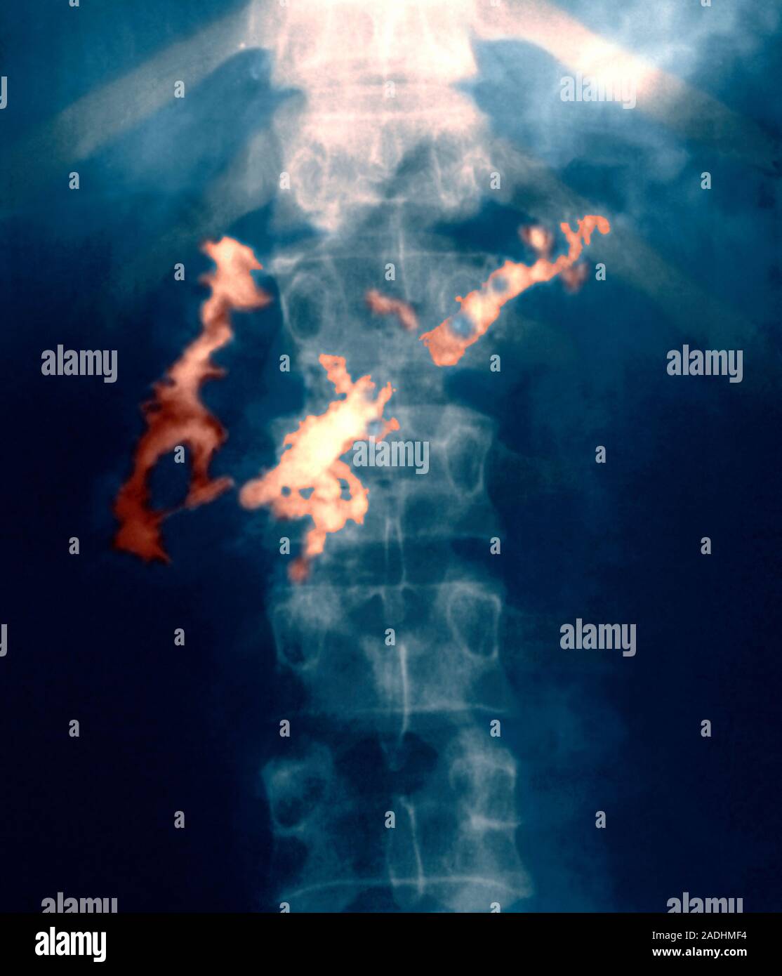 Inflamed pancreas, coloured frontal X-ray. The pancreas (red) has been ...