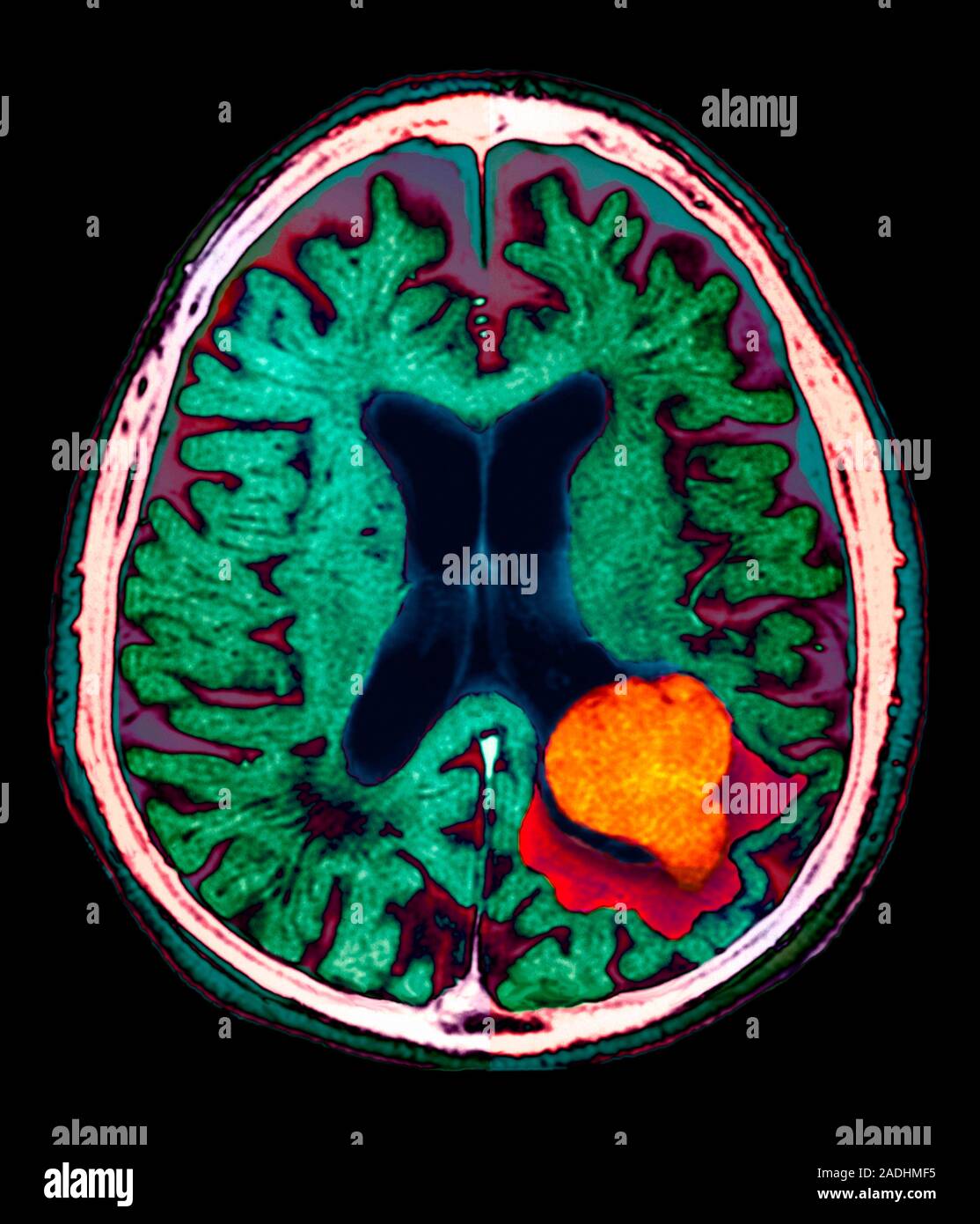Brain Lesion Coloured Axial Horizontal Magnetic Resonance Imaging Mri Scan Through The Head