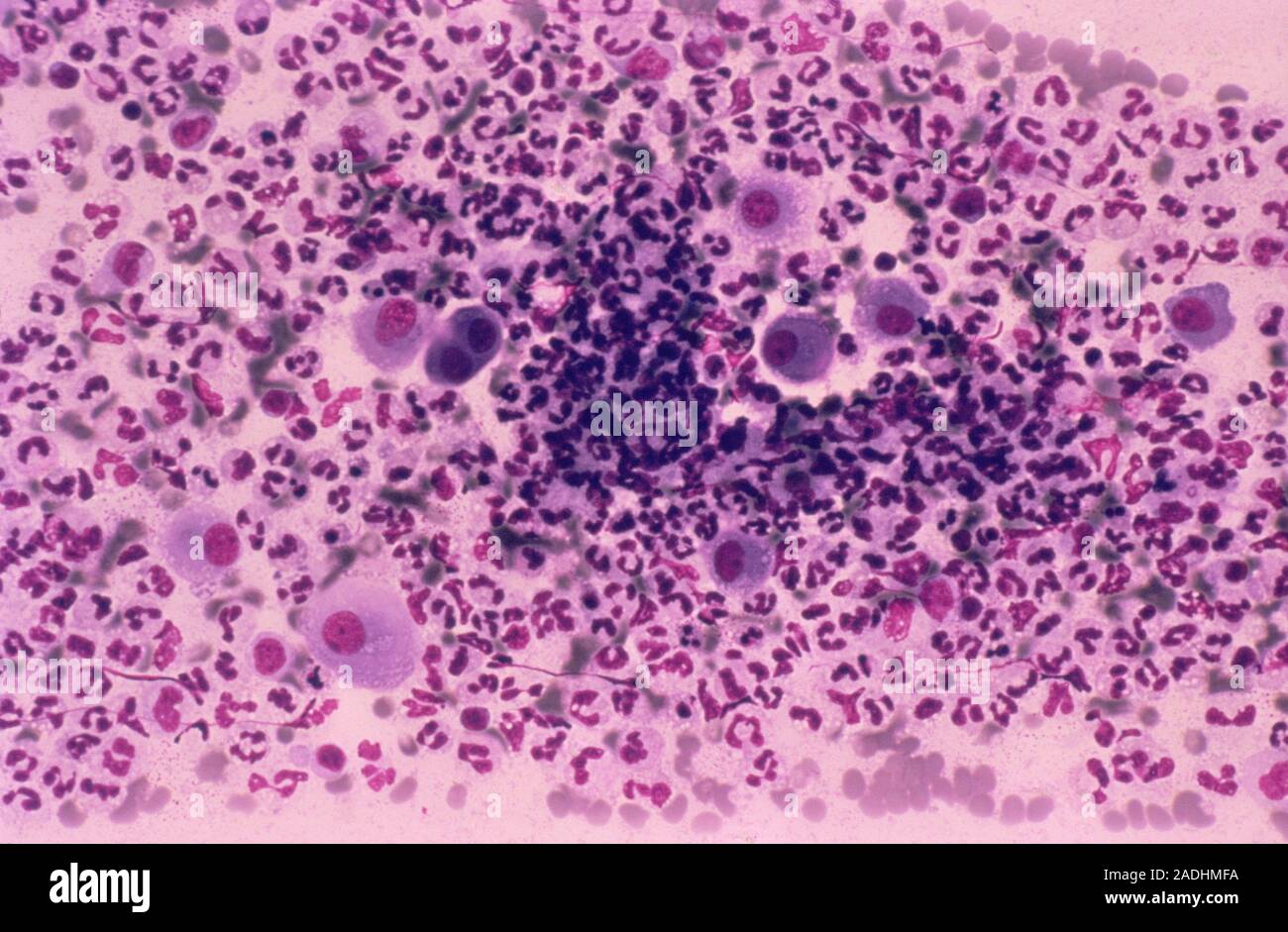 Pleurisy. Light micrograph of a section through lung tissue showing ...