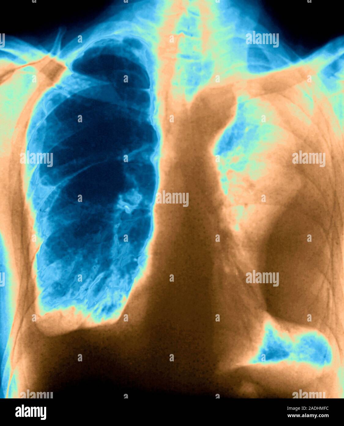Pleurisy of the lungs. Coloured X-ray of a patient's chest showing ...