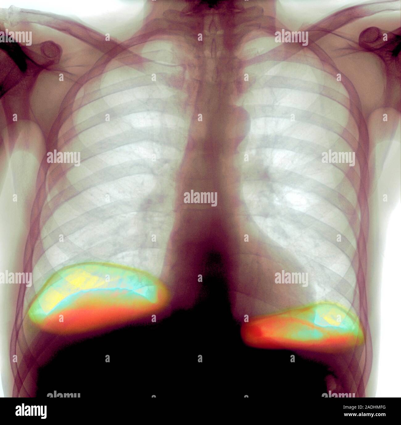 Abdominal air pocket. Coloured X-ray of air in the abdomen, a condition ...