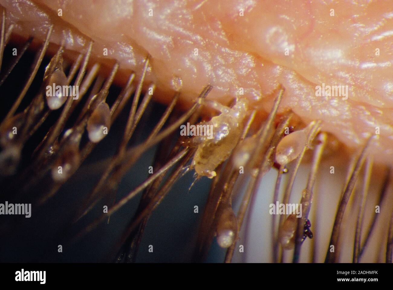 Eyelash lice infestation. Close-up of a patient's eyelashes showing a ...