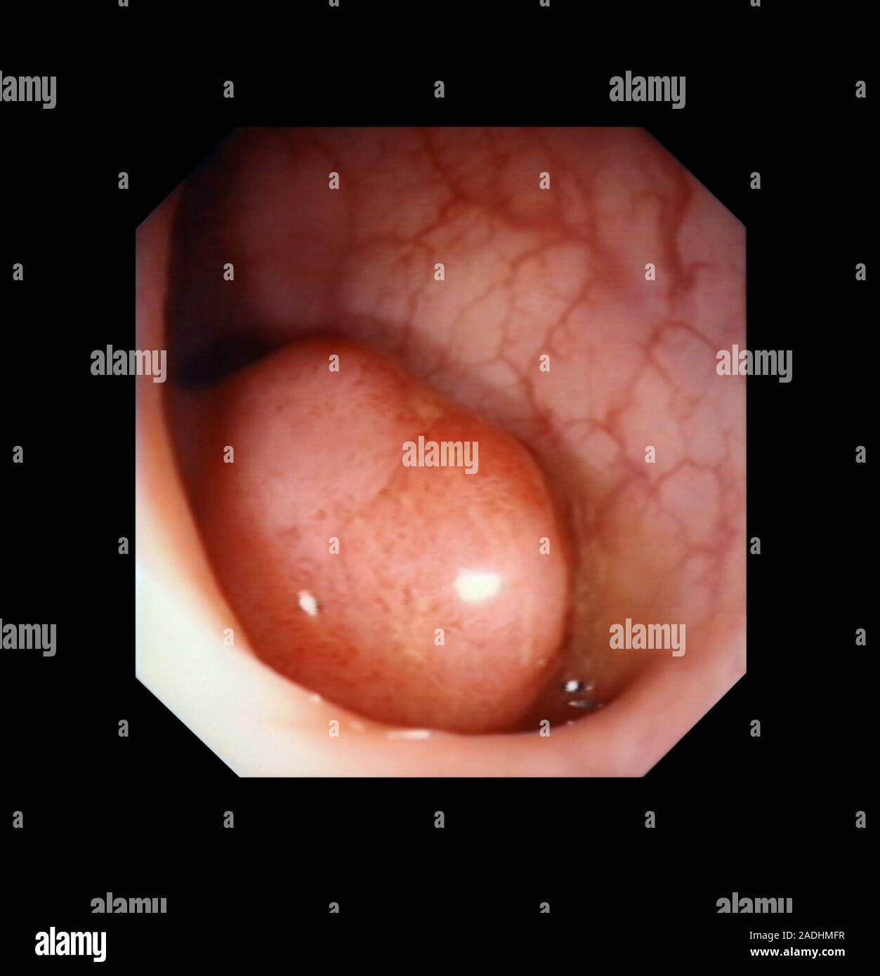 Colonic Polyp Endoscope View Polyps Are Benign Growths They Often Cause No Symptoms But May