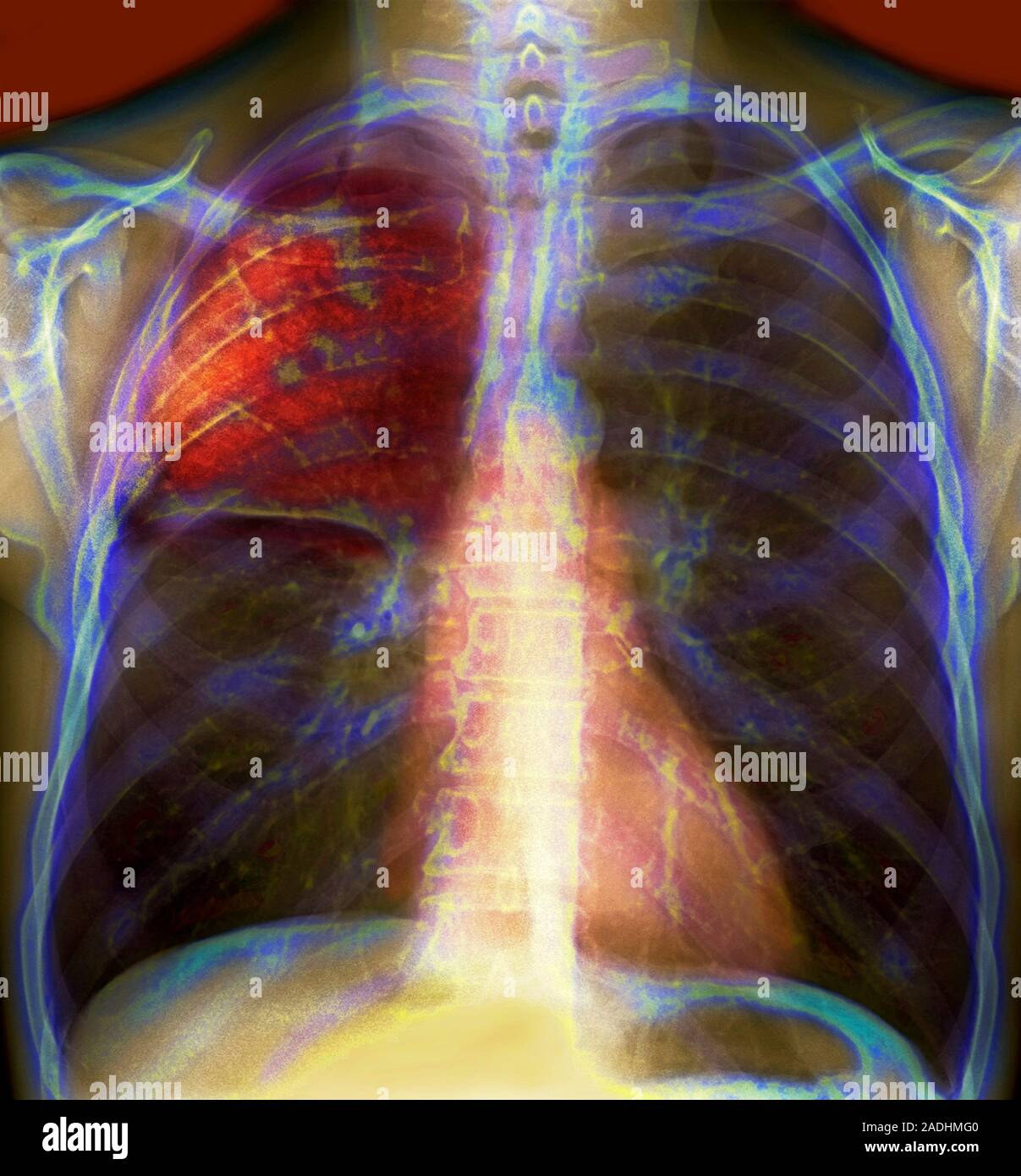 Pneumonia. Coloured chest X-ray of a pneumonia infection (red) in the ...