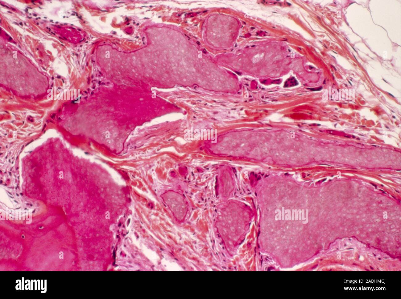Pilomatrixoma tumour. Light micrograph of a section through a tumour ...