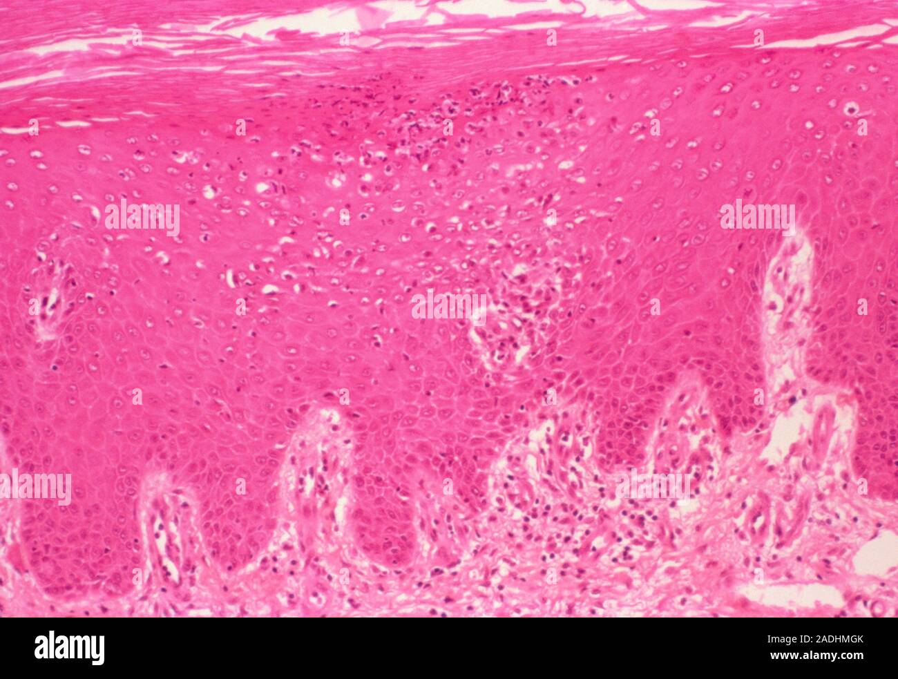 Psoriasis. Light micrograph of a section through a psoriasis pustule ...